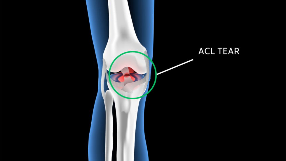 Physical Therapy For ACL Tear Recovery and Prevention